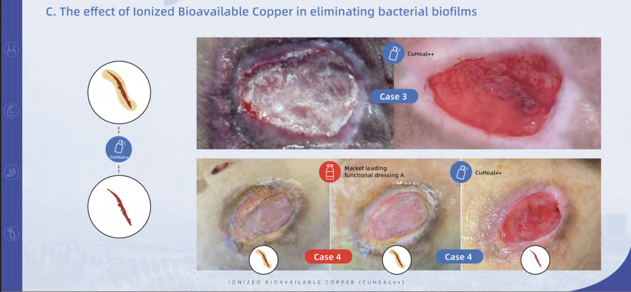 Bacterial Biofilm treatment, Diabetes Wound Treatment, Wound Treatment ...