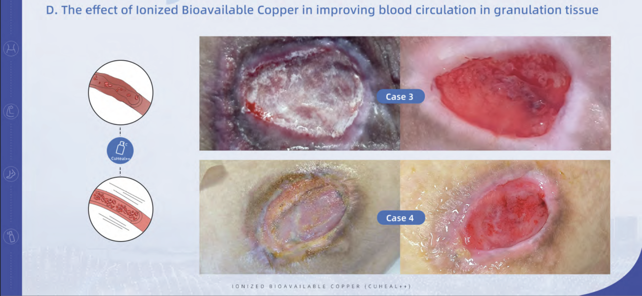 Bacterial Biofilm treatment, Diabetes Wound Treatment, Wound Treatment ...